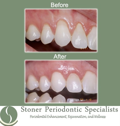 Frequently Asked Questions About Gum Recession Treatment