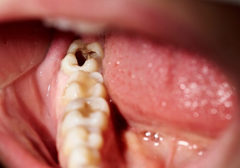 What Causes a Tooth Infection?